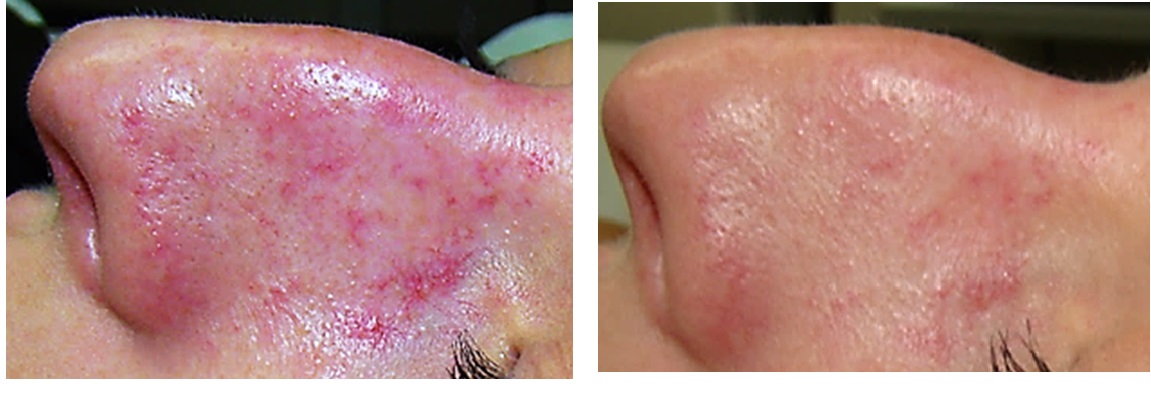 Rosacea & vascular Treatment Victoria BC | COL Center