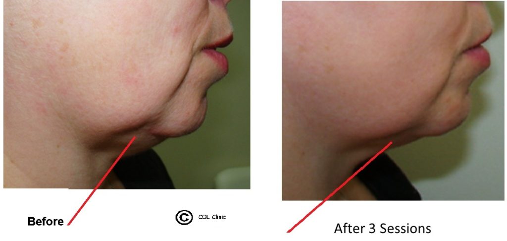 Laser Neck Lift | COL Center