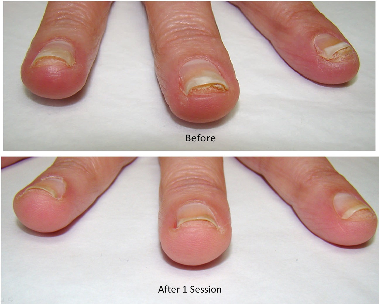 Laser Therapy for Nail Fungus* – Canadian Optic & Laser Rejuvenation ...
