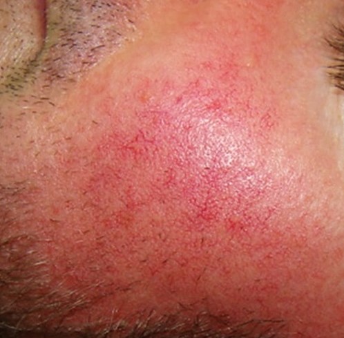What is Rosacea? – Canadian Optic & Laser Rejuvenation Center (COL Center)